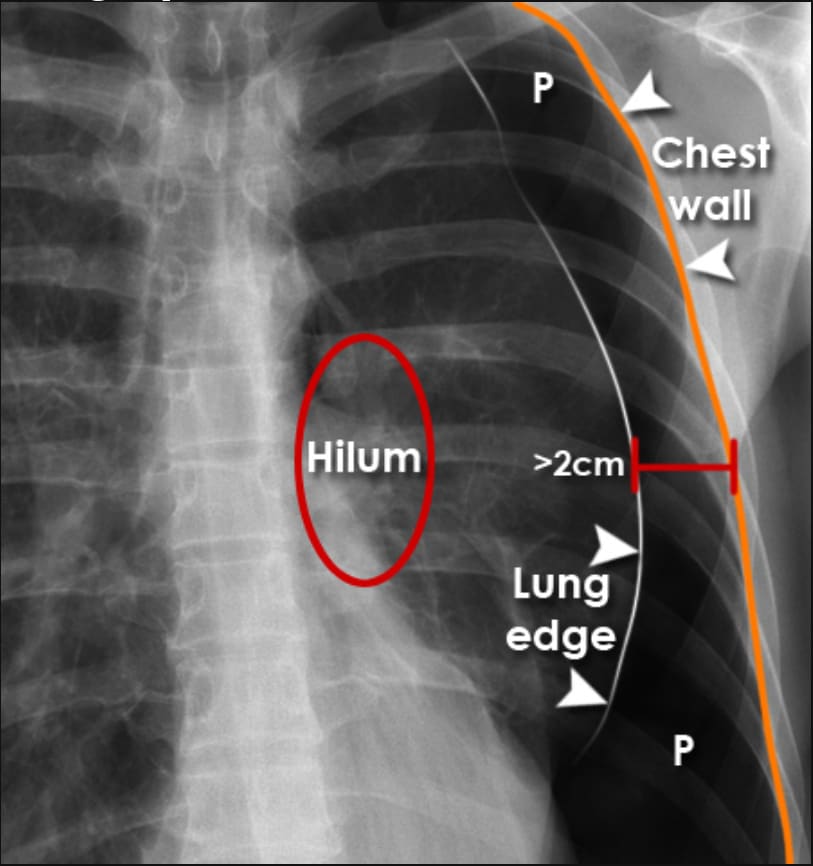 Normal vs. Abnormal Chest X-Rays: What Do They Reveal?