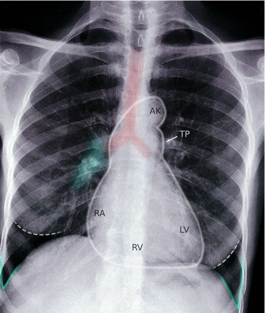 Normal Chest X Rays Pictures Chest X Ray Findings In 636 Ambulatory