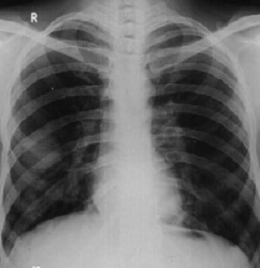 Normal vs. Abnormal Chest X-Rays: What Do They Reveal?