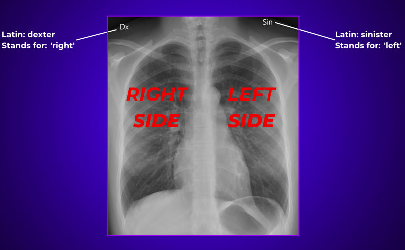 Normal vs. Abnormal Chest X-Rays: What Do They Reveal?