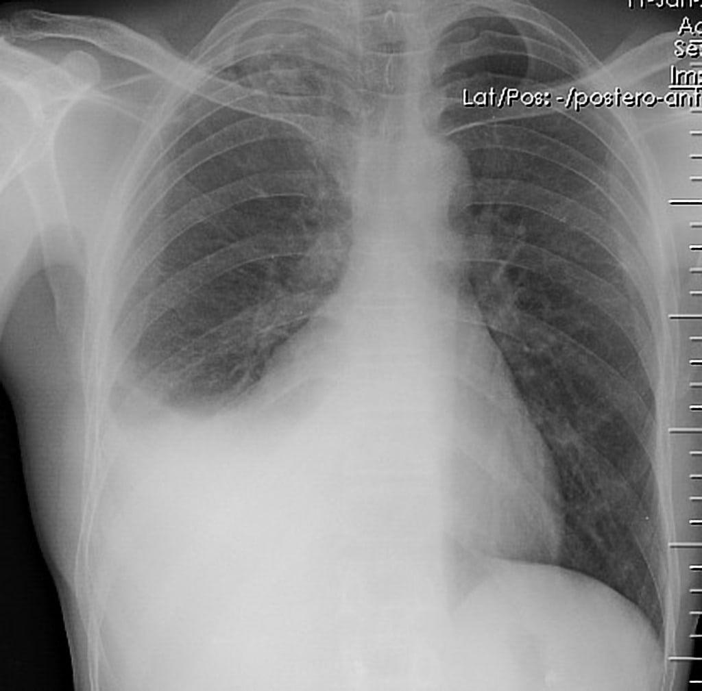 What is the Difference Between Pleural Effusion and Pulmonary Edema?