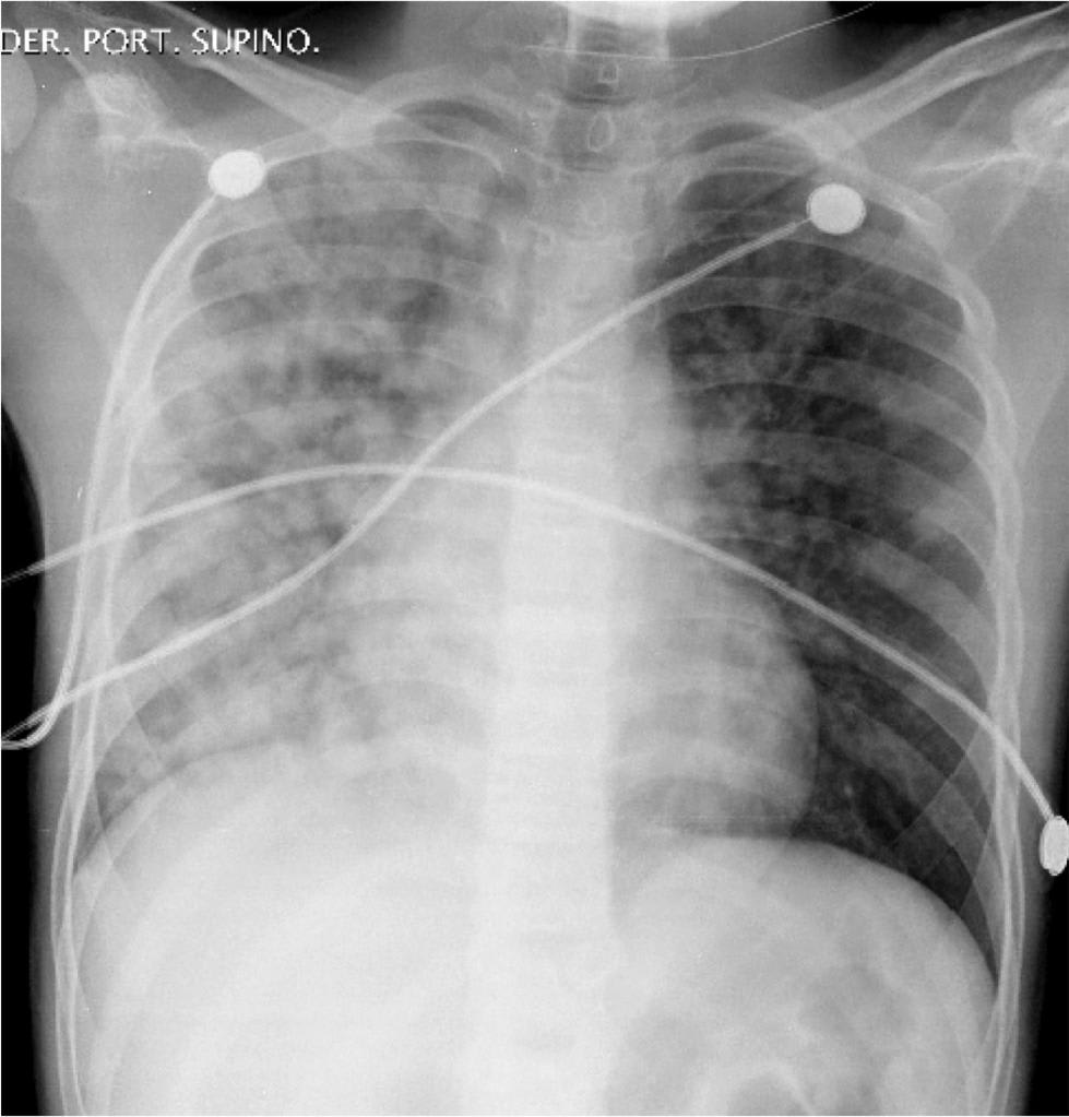 What is the Difference Between Pleural Effusion and Pulmonary Edema?