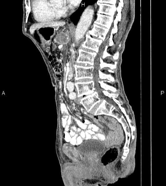 Understanding the Scaphoid Abdomen