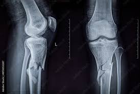 What Is a Comminuted Fracture?