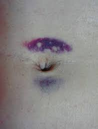 Understanding Cullen's Sign: A Blue Belly Button Signal You Shouldn't ...