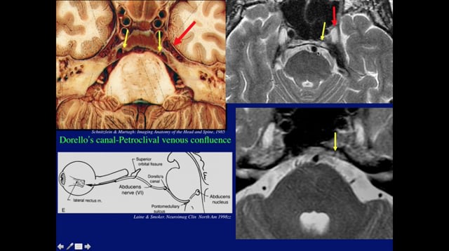 Imaging the Abducent (VI) Nerve. Nov. 3, 2015