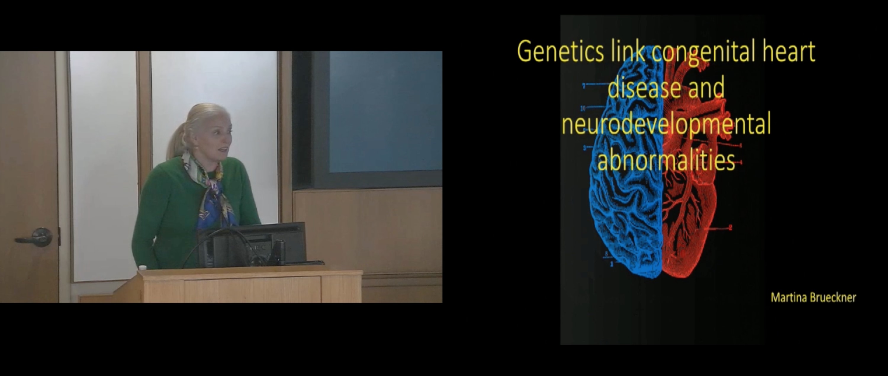 Genetics link congenital heart disease and neurodevelopment abnormalities