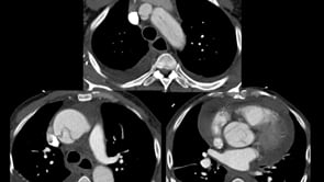Bhalla: "Acute Aorta: Dissection, IMH and PAU