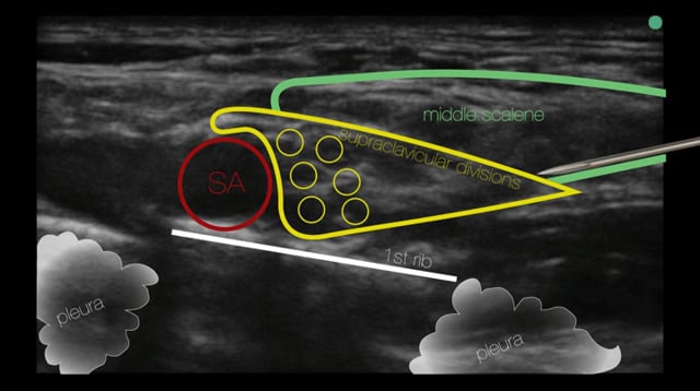 Supraclavicular Block