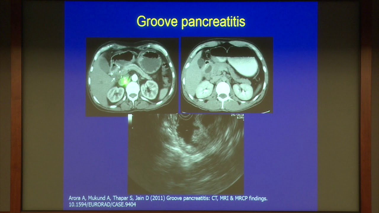 The Differential Diagnosis of Pancreatic Mass: The Rule Outs