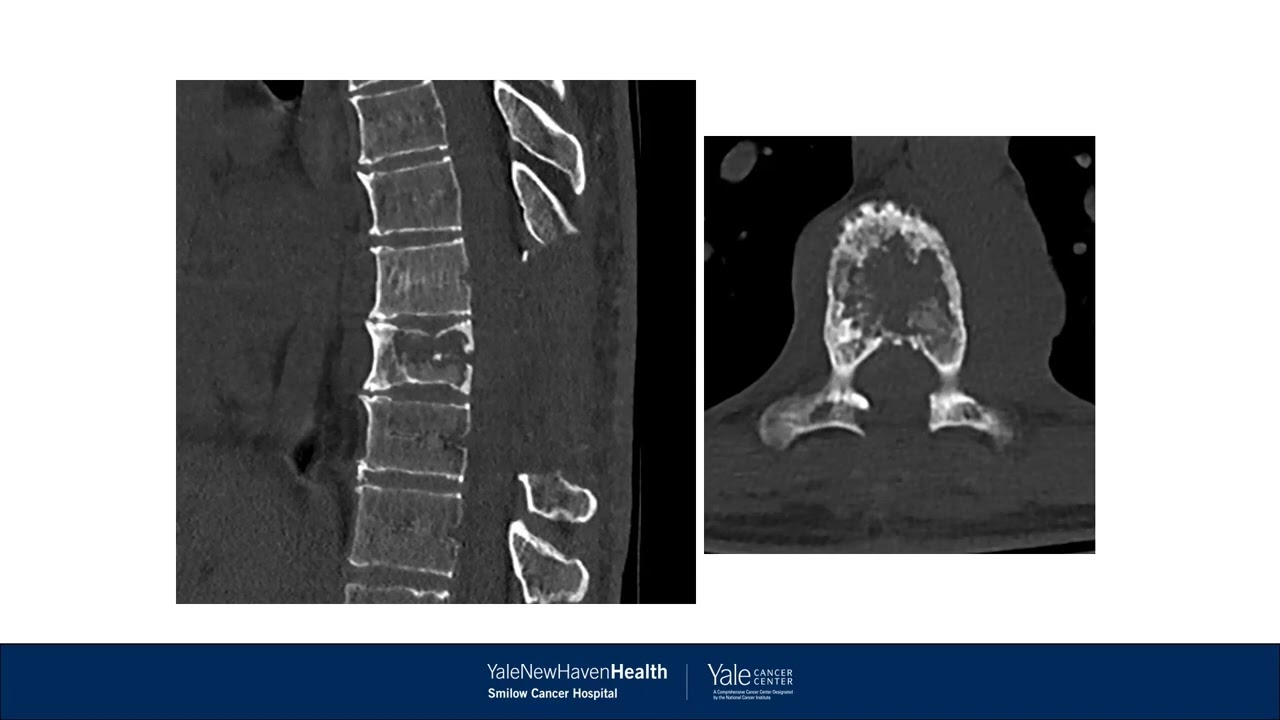 Yale Urology Grand Rounds: Surgical Management of Spine Tumors