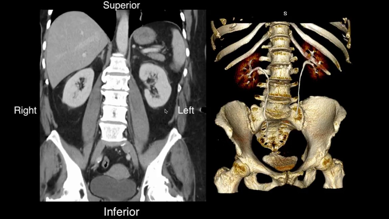 Normal CT Renal Anatomy