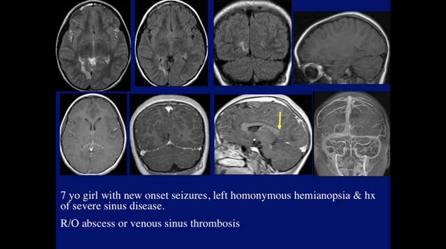 "Imaging the corpus callosum" Jan. 27, 2016