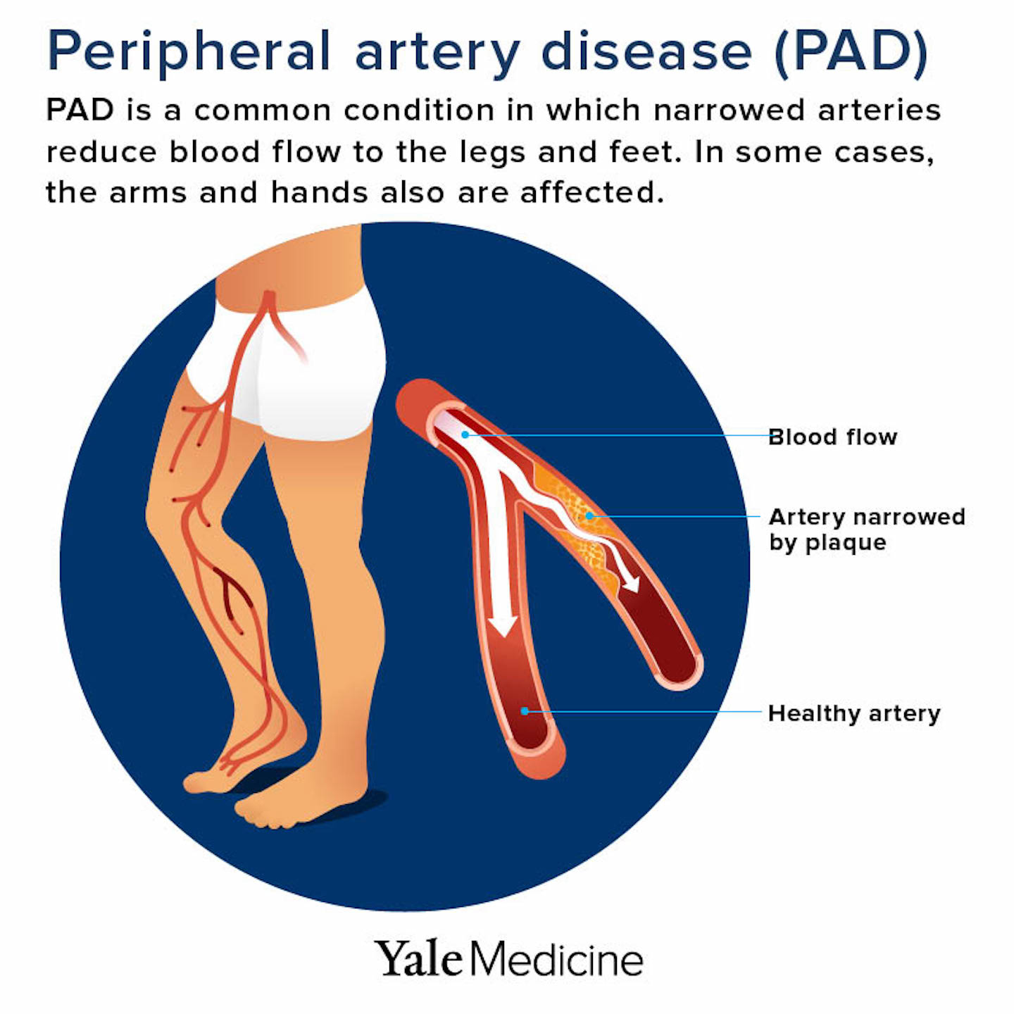 Peripheral Artery Disease Is Poorly Understood—And Yale Researchers Are ...