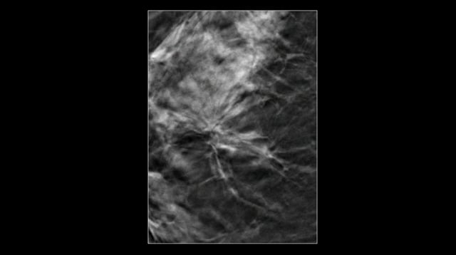 Mammo fellowship clip