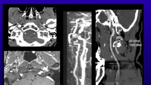 Schaefer: "Acute Ischemic Stroke: Algorithm for Diagnosis, Triage and ...
