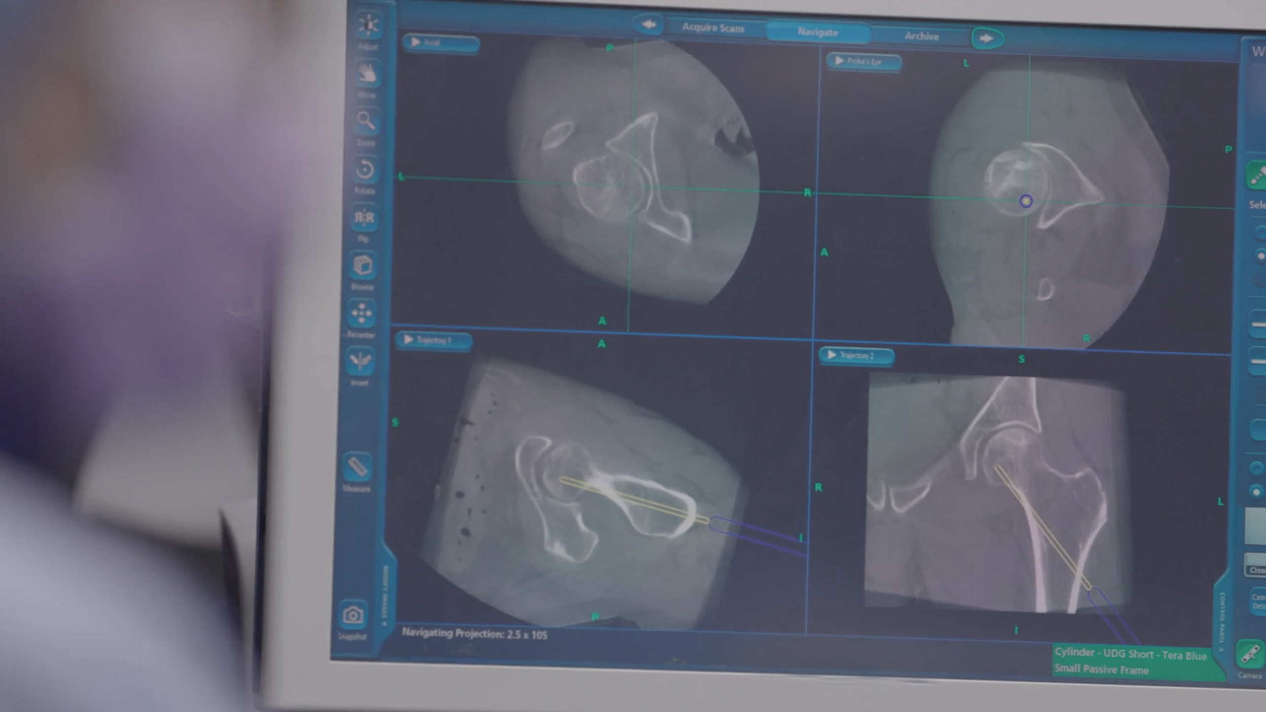 Minimally Invasive Avascular Necrosis Treatment Is Developed at Yale, Combining 3D Modeling With ...