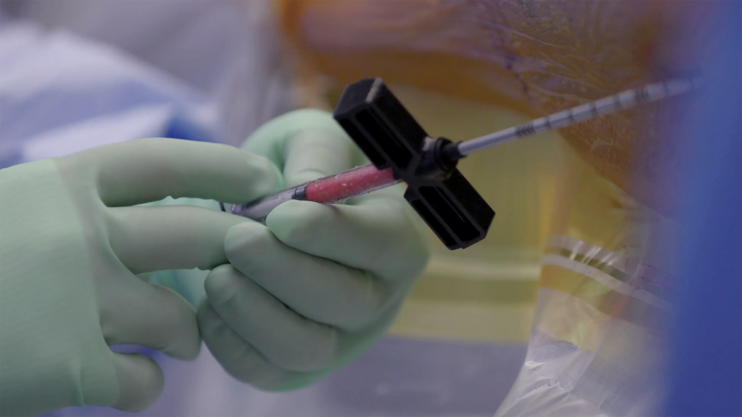 Minimally Invasive Avascular Necrosis Treatment Is Developed at Yale, Combining 3D Modeling With ...