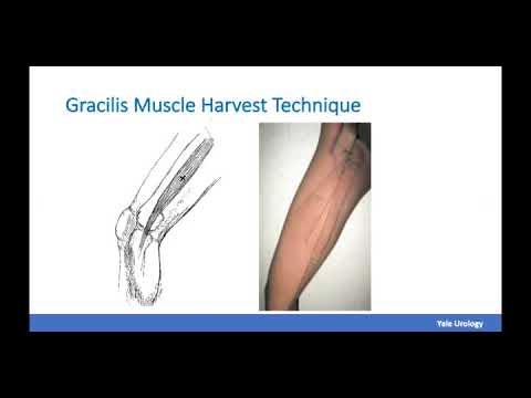 "The Gracilis Muscle Flap: Versatile Applications in Urology"