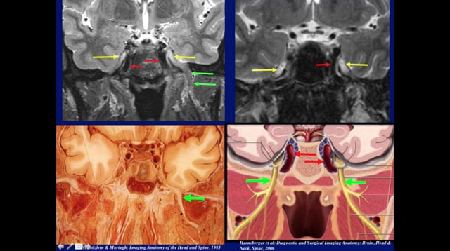 Imaging the mandibular nerve. Dec. 1, 2015
