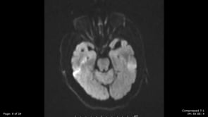 Axial DWI Brain MRI