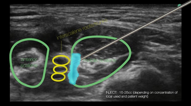 Interscalene Block