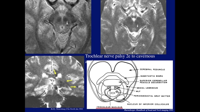 Imaging the Trochlear (IV) Nerve and the Medial Longitudinal Fasciculus ...