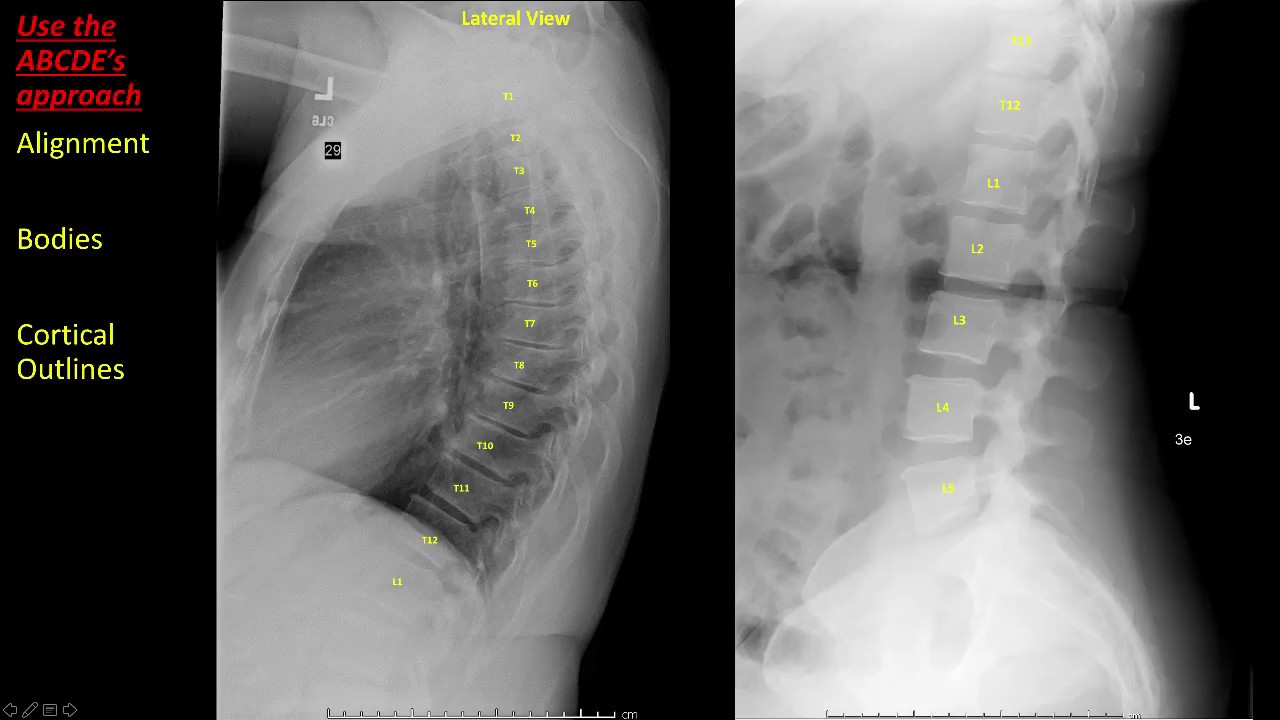 Introduction to Spine Radiology