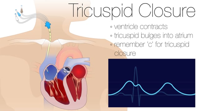 Understanding CVP Waveforms