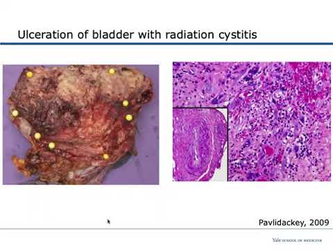 Management of Radiation-Induced Hemorrhagic Cystitis