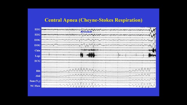 The ASV Story What We Can Learn From Failure -- Dr. David M. Rapoport, MD